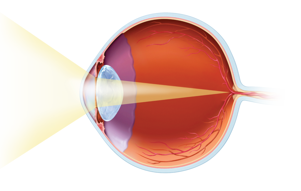 The Future of Cataract Surgery: RxSight Light Adjustable Lens (LAL ...