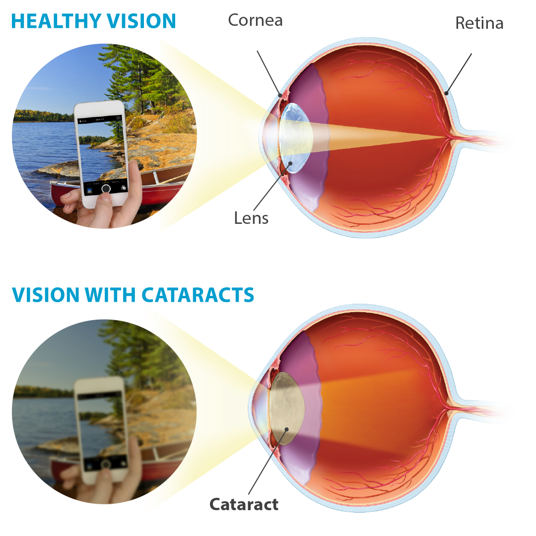 Cataracts | Commonwealth Eye Surgery
