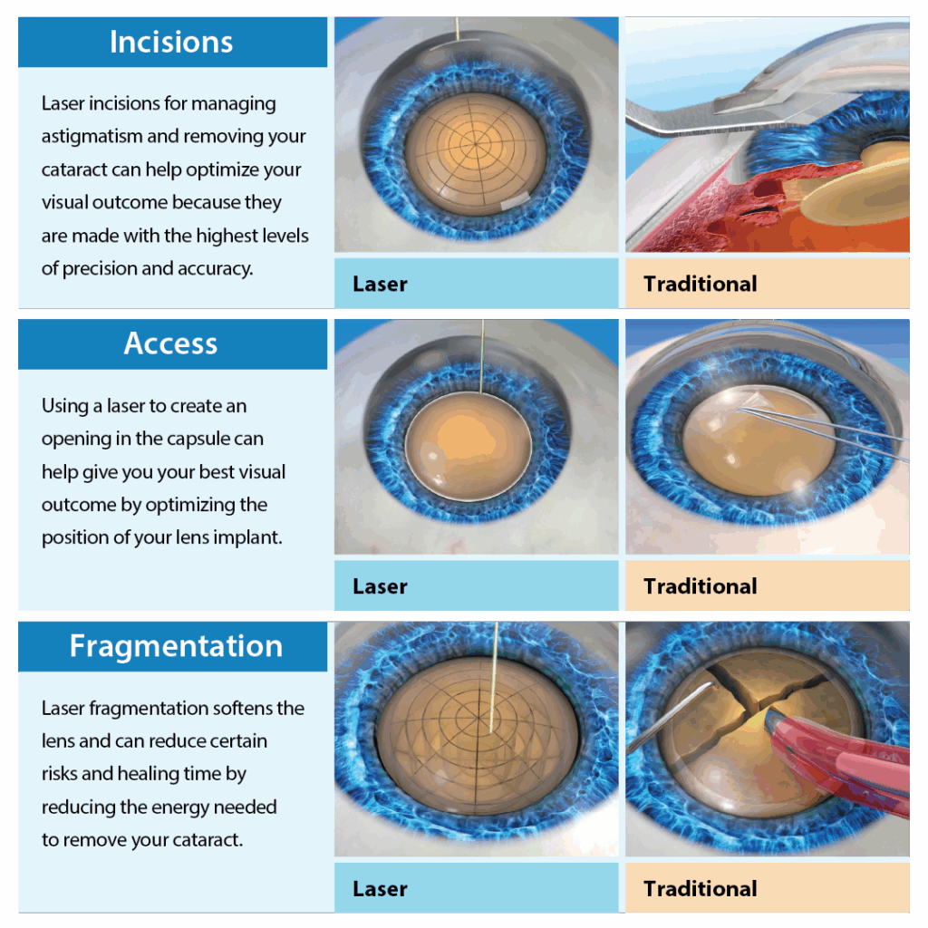 Laser Cataract Surgery | Commonwealth Eye Surgery